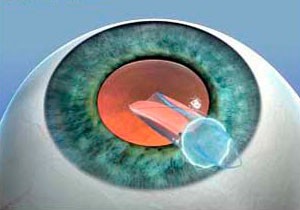 intra-oculares - Clínica de Olhos Manaus